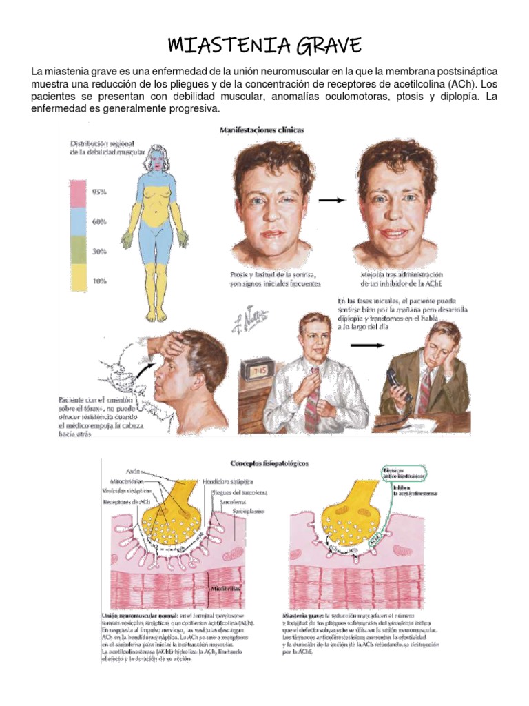 Miastenia Grave | PDF | Medicina CLINICA | Especialidades Medicas