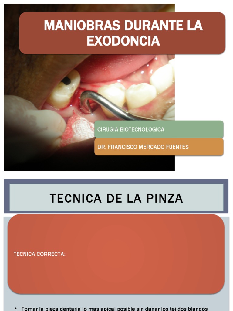 Maniobras de La Exodoncia | PDF