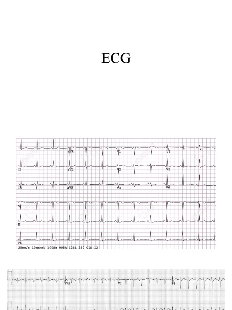 Ecg Interpretation For Internship | PDF