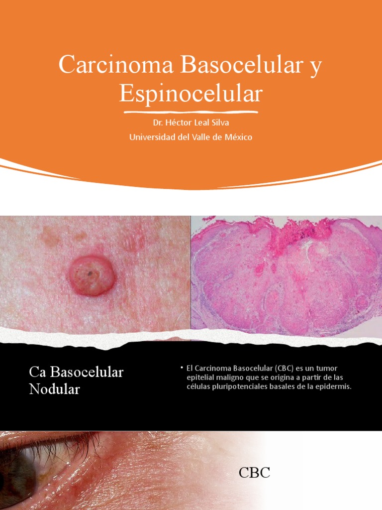 Carcinoma Basocelular y Espinocelular | Descargar gratis PDF | Cáncer ...