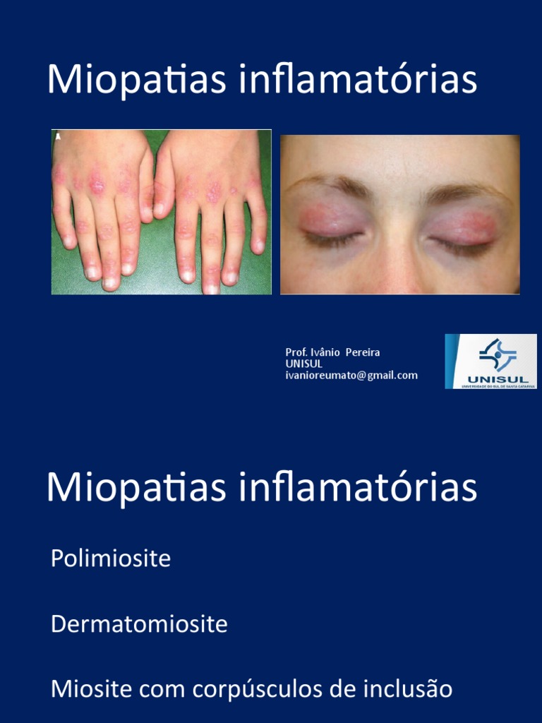 Aula Miosites - Ivanio | PDF | Célula T | Medicina Clínica