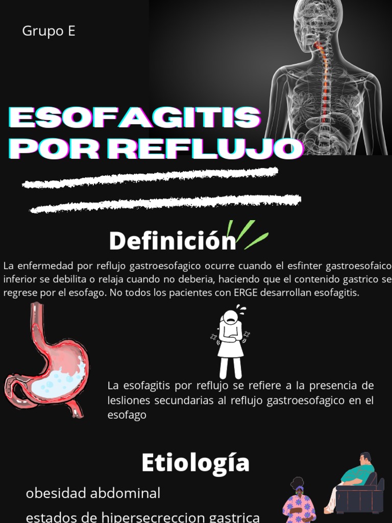 Guía de Esofagitis por Reflujo | PDF | La enfermedad por reflujo ...