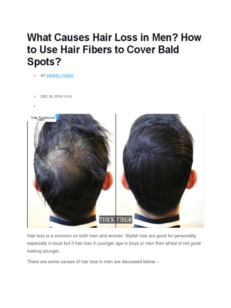 Causes of Hair Loss in Men | PDF | Hair Loss | Hair