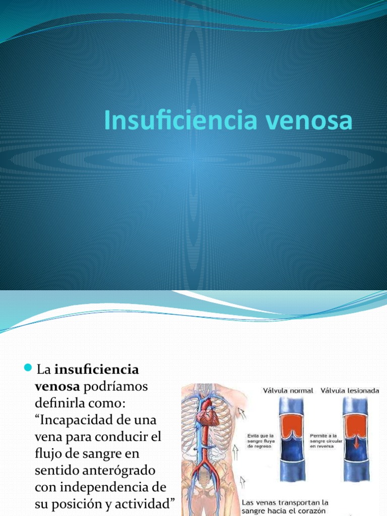 Insuficiencia Venosa Care Guide Information En Espanol – TASEAL