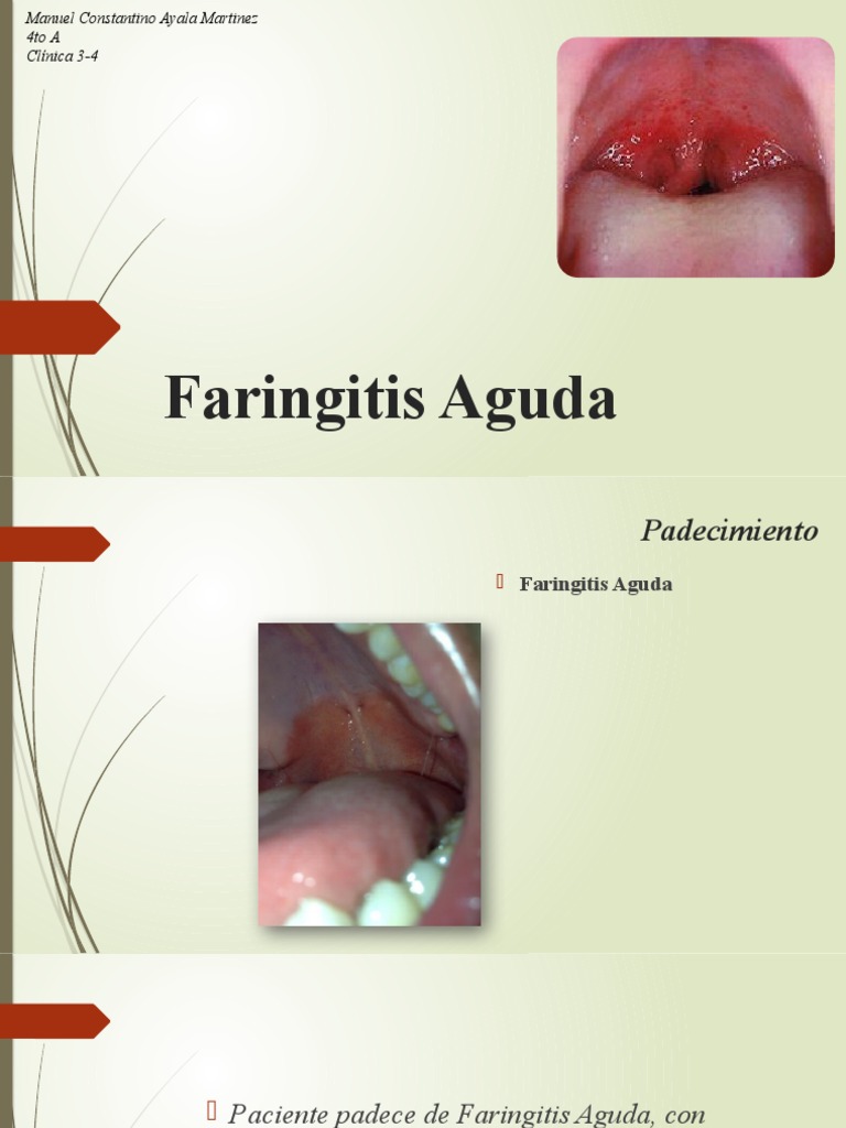 Faringitis Aguda | PDF | Causas de la muerte | Epidemiología