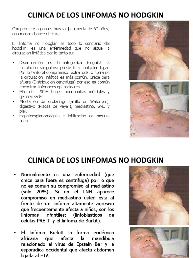 Linfomas No Hodgkin | PDF | Linfoma | Sistema inmune