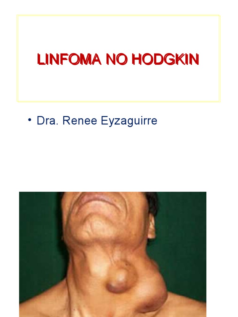 Linfoma No Hodgkin Linfoma No Hodgkin: - Dra. Renee Eyzaguirre | Descargar gratis PDF | Linfoma ...