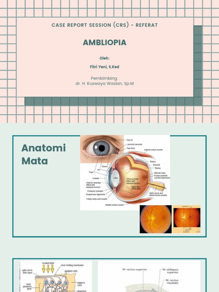 Ambliopia | PDF