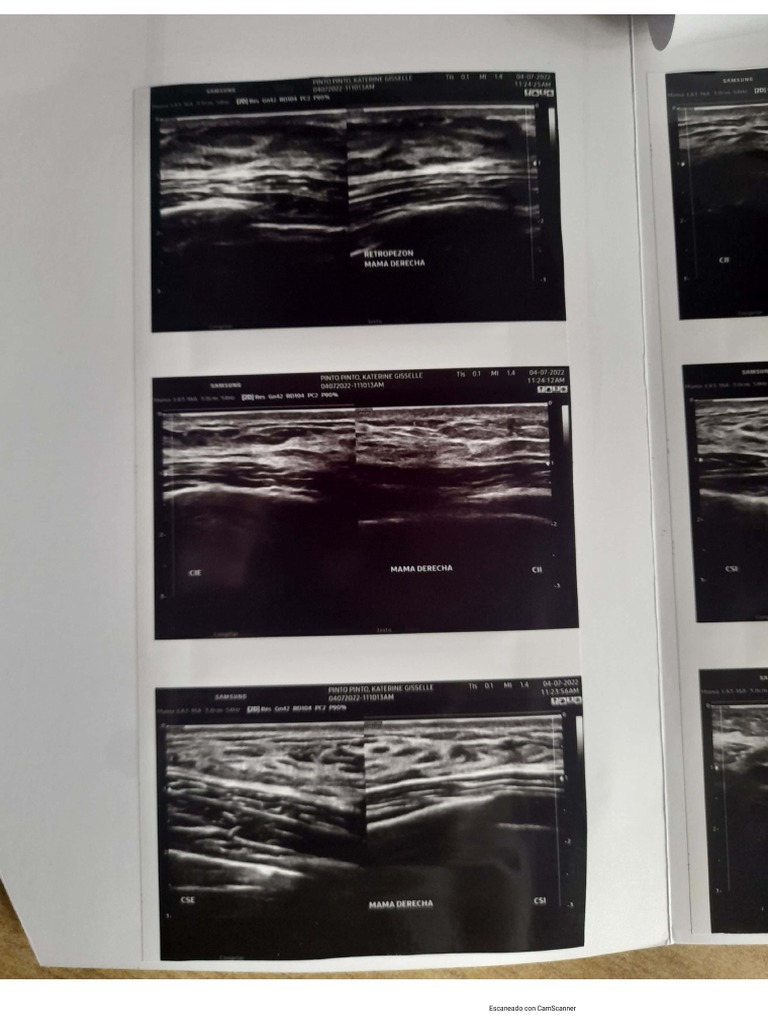 Ultrasonido Mamario | PDF