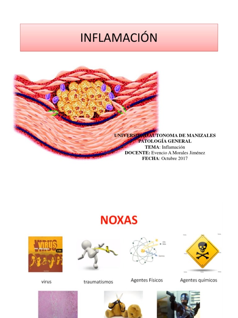 Inflamación Aguda Generalidades | PDF | Inflamación | Sistema inmune