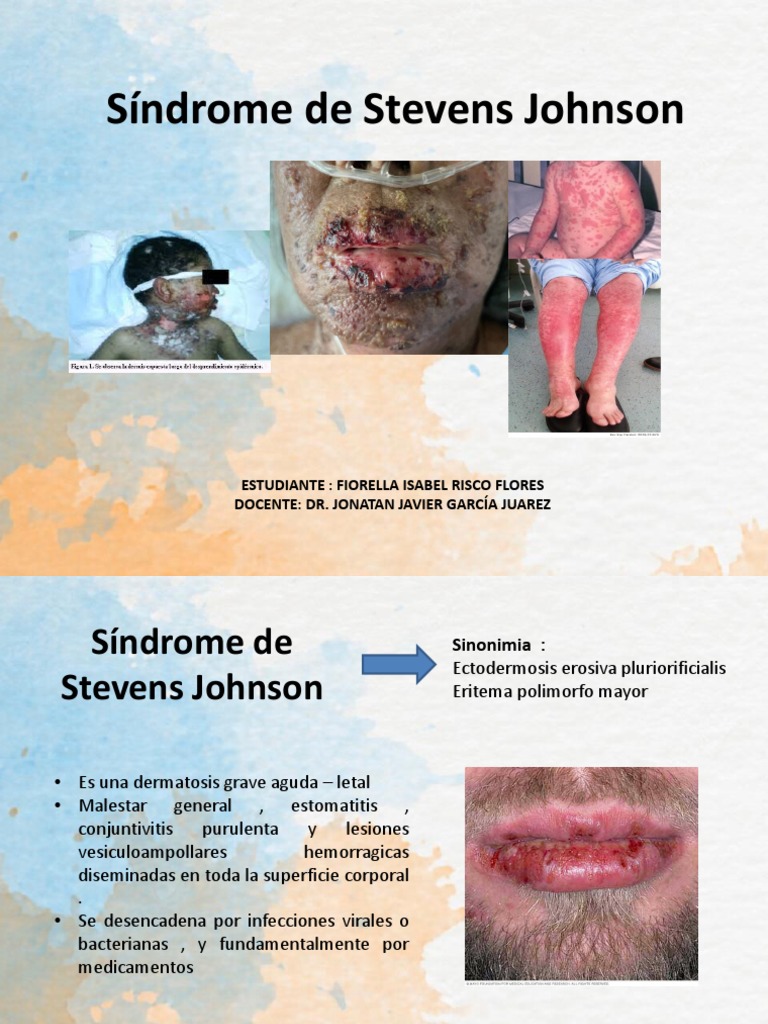 Síndrome de Stevens Johnson | PDF | Medicina CLINICA | Enfermedades y ...