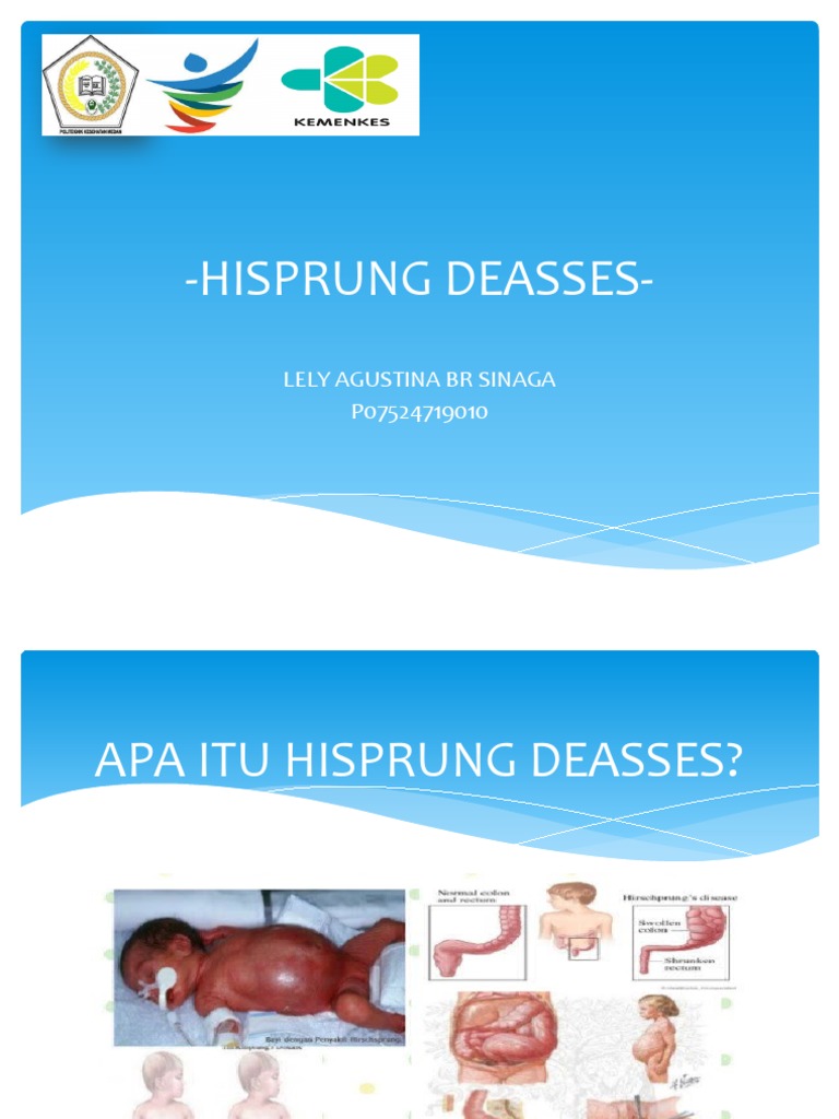 Hisprung Deasses | PDF