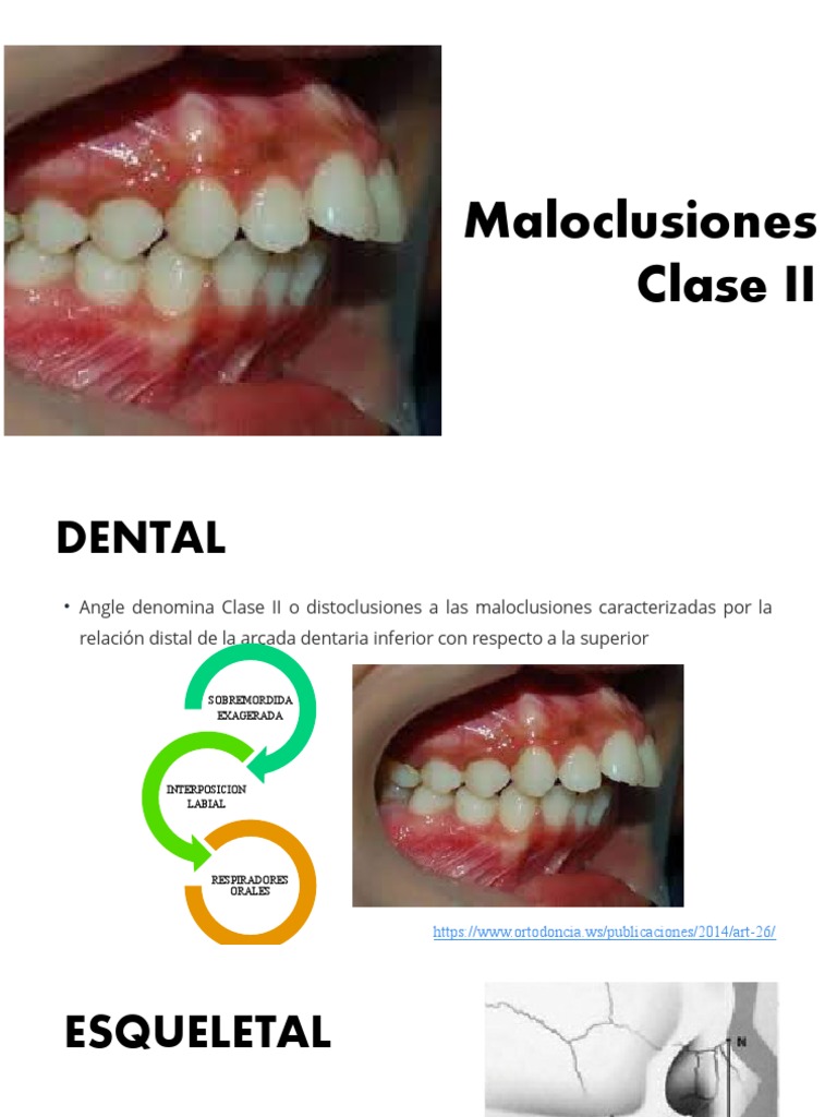 Maloclusiones Clase II | PDF | Ortodoncia | Ramas de Odontología