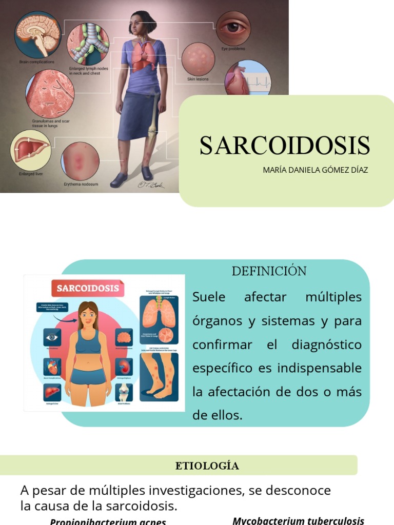 SARCOIDOSIS | PDF | Inmunología | Especialidades Medicas
