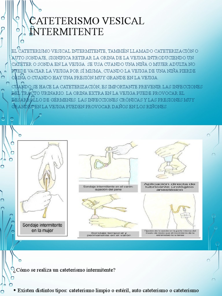 Cateterismo Vesical Intermitente | PDF | Vejiga urinaria | Anatomia animal