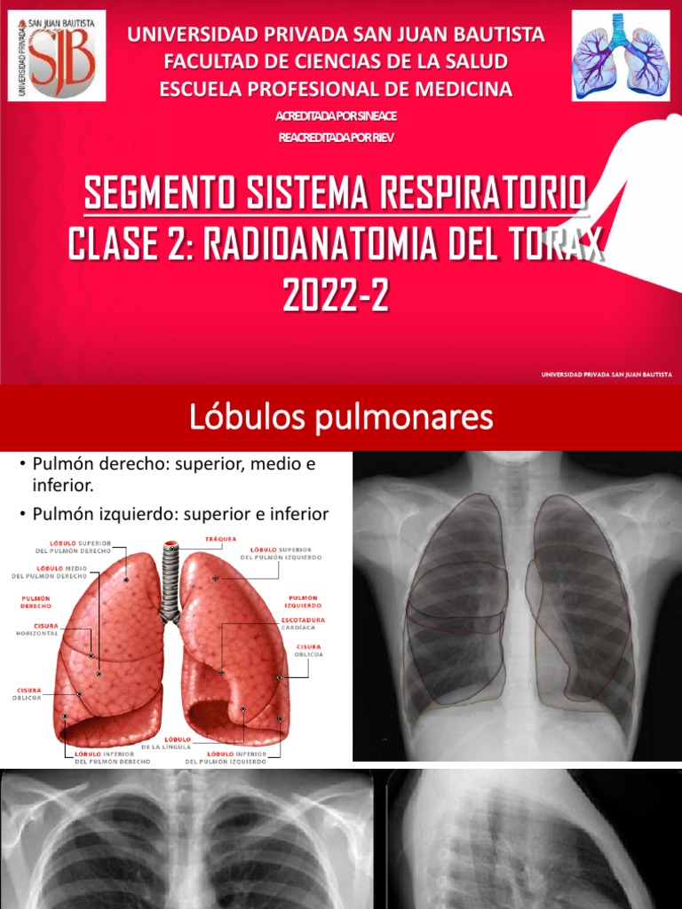Patrones radiológicos pulmonares: el patrón intersticial | PDF | Pulmón ...