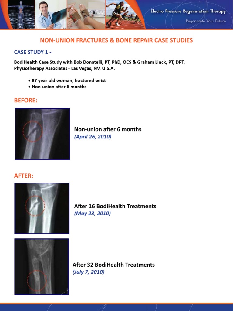 Non Union Fractures Bone Repair Case Studies | PDF | Skeletal System ...