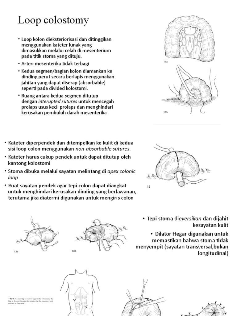 Colostomy | PDF | Perjalanan | Sains & Matematika