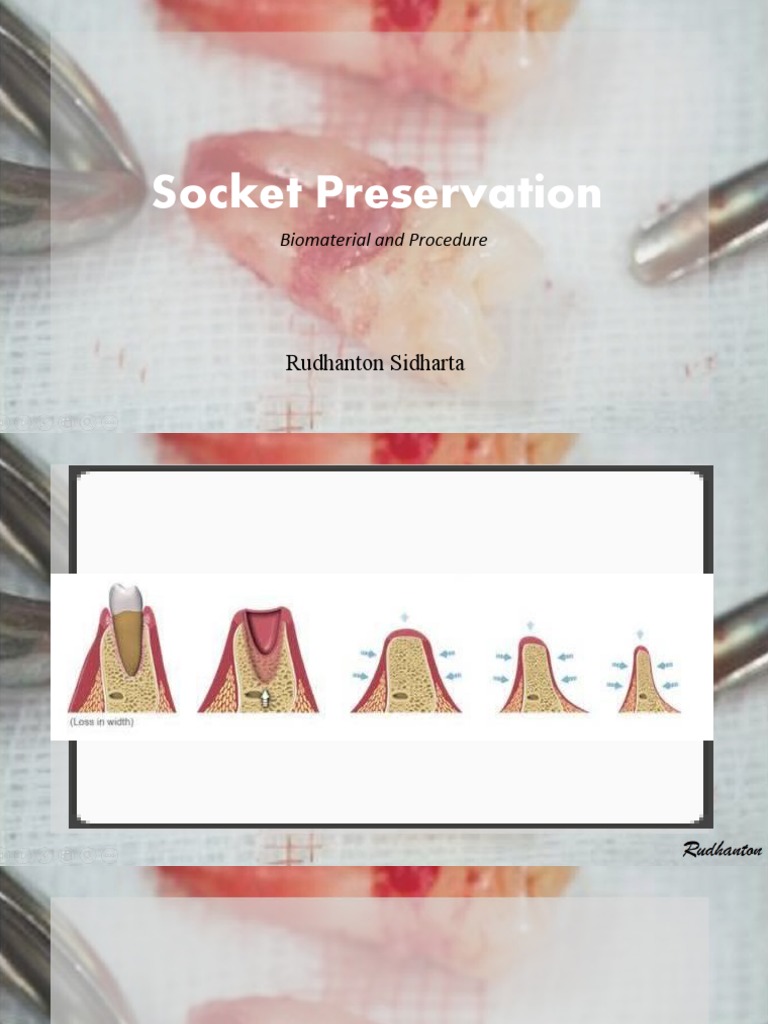 Socket Preservation Procedure II | PDF | Osteoblast | Clinical Medicine