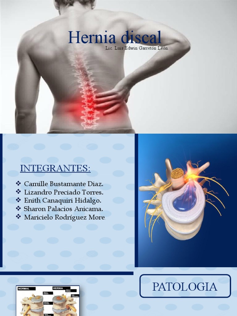 Hernia Discal | PDF
