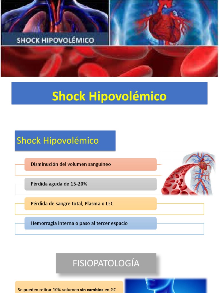 Shock Hipovolémico | PDF | Septicemia | Medicina CLINICA