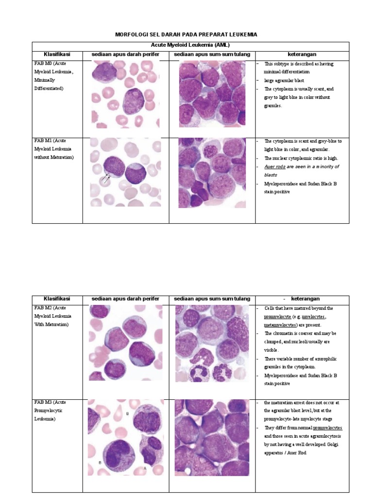Morfologi Darah Leukemia | PDF