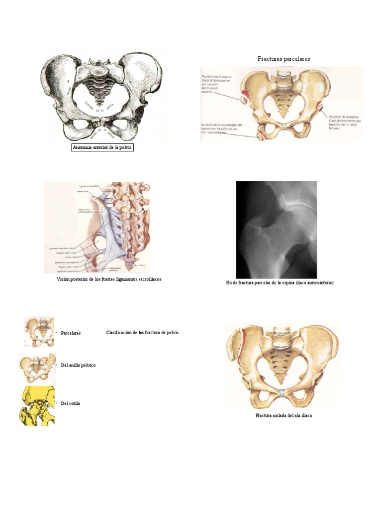 Fracturas De Pelvis Pdf Pelvis Cadera