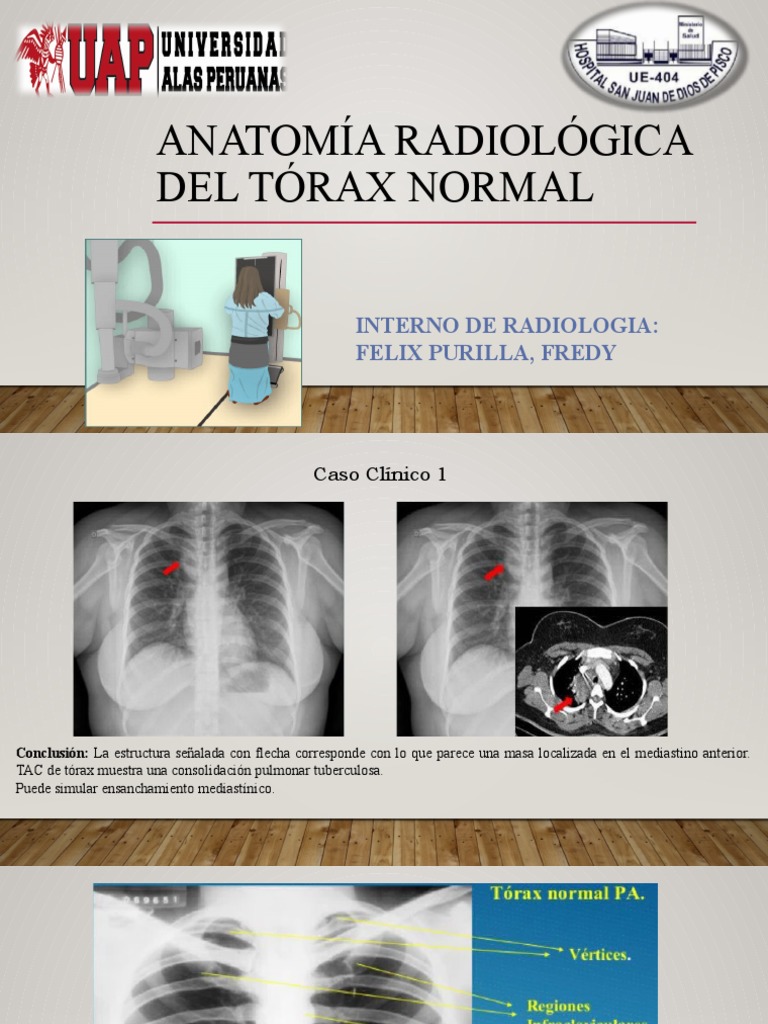 Anatomía Radiológica del Tórax Normal | PDF