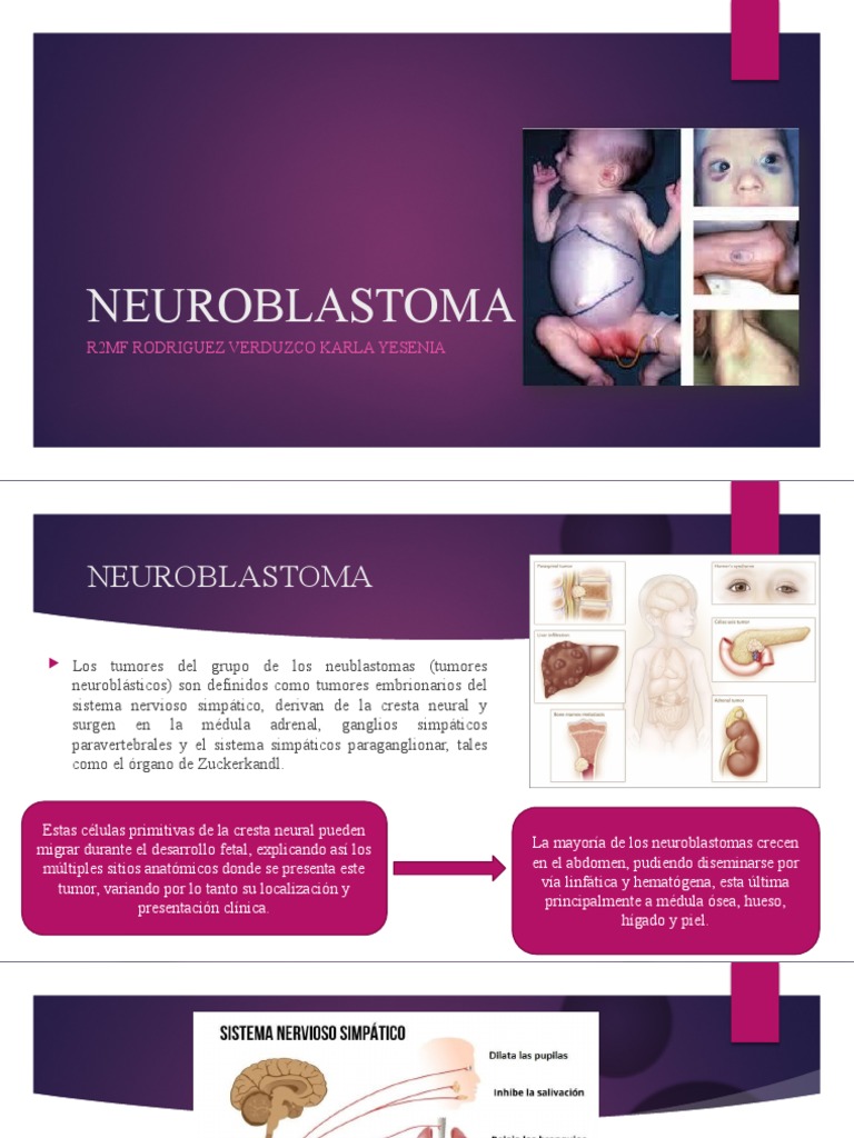Neuroblastoma: Epidemiología y Tratamiento | PDF