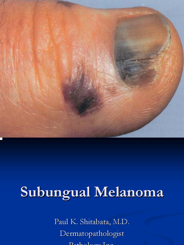 Subungual Melanoma | Melanoma | Nail (Anatomy)