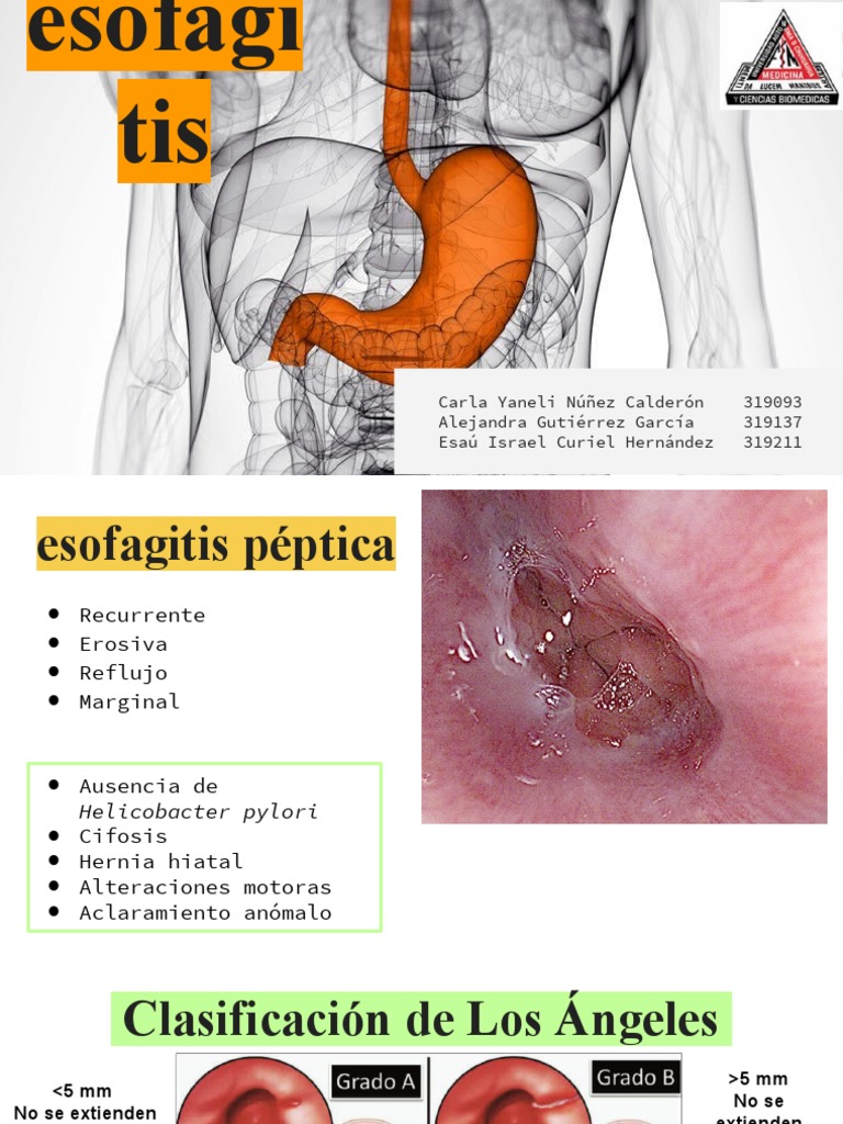 Clasificación y Tratamiento de Esofagitis | PDF