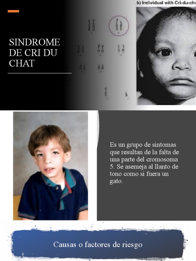 Síndrome de Cri du Chat: Síntomas y Causas | PDF