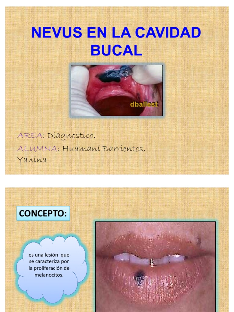 Nevus en La Cavidad Bucal | PDF