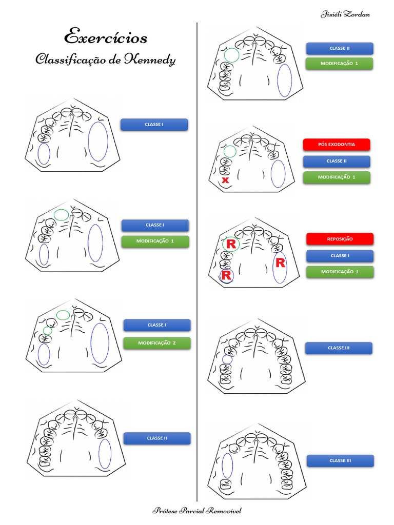Exercícios - Classificação de Kennedy e Modificações de Rumpel | PDF