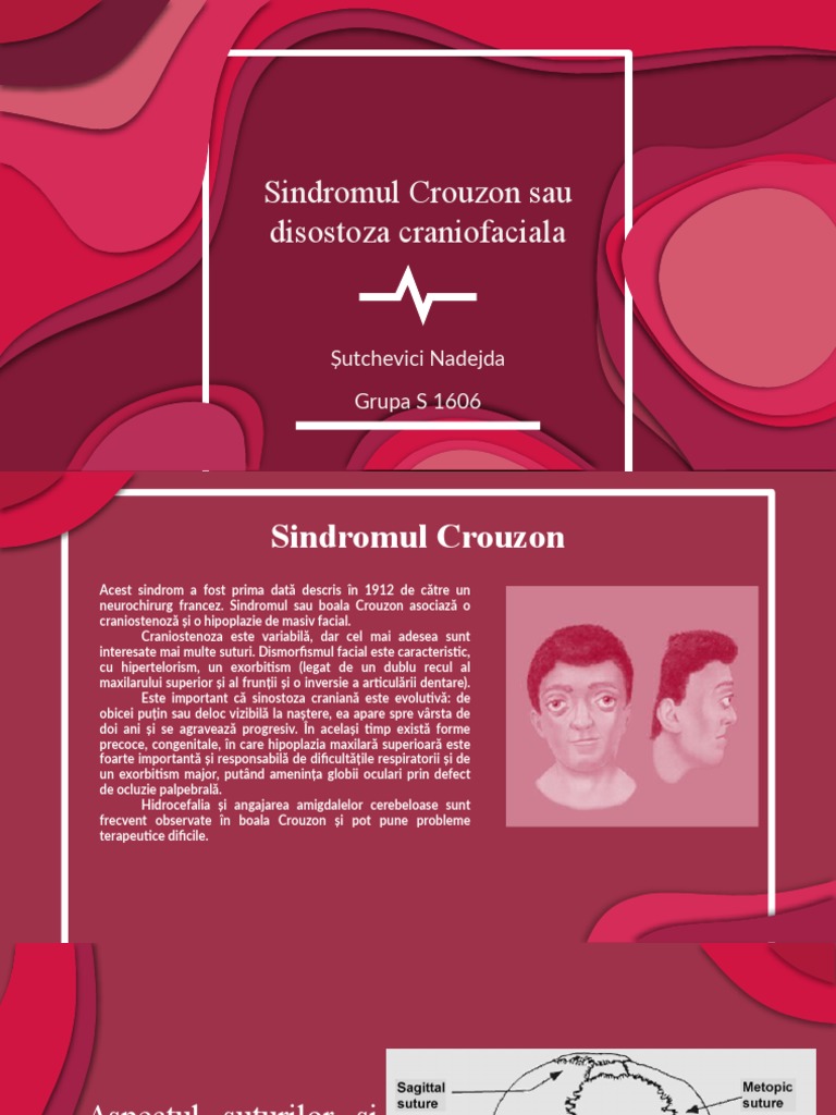 Sindromul Crouzon | PDF