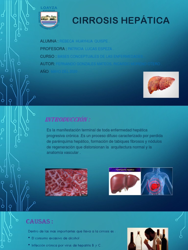 Cirrosis Hepática Pdf Cirrosis Hepatitis C