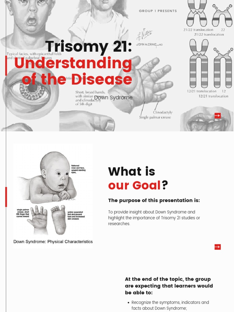 Understanding Down Syndrome and Trisomy 21 | PDF | Down Syndrome ...
