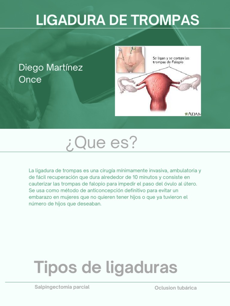 Ligadura de Trompas | PDF | Salud sexual | Medicina