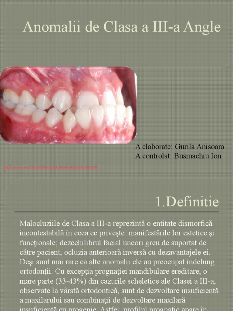 Malocluzia Clasa III Angle | PDF