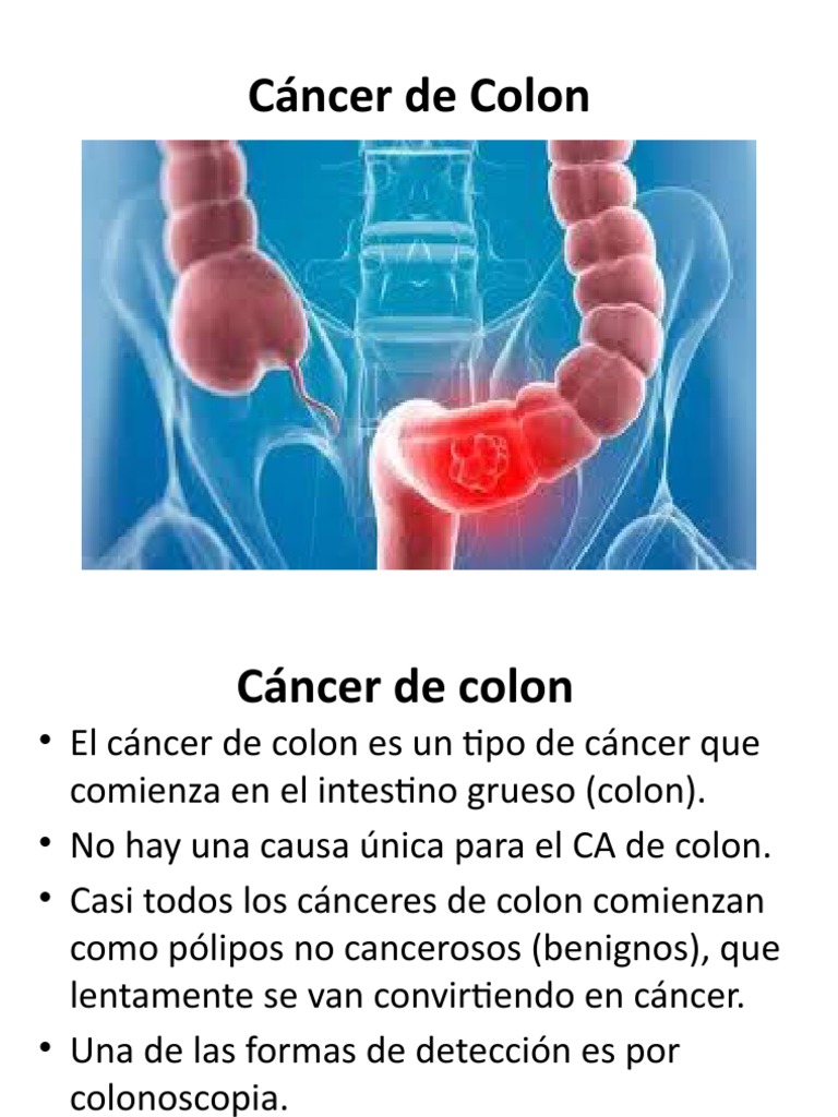 Cáncer de Colon: Causas, Síntomas y Tratamientos | PDF | Cáncer ...
