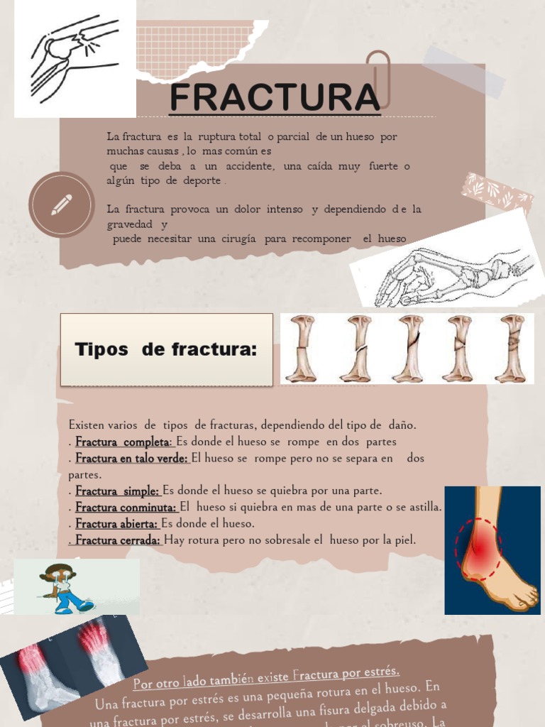 Fractura | PDF