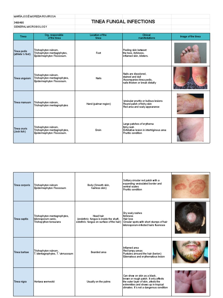 Tinea Fungal Infections: Types, Causes, Symptoms | PDF | Fungus ...