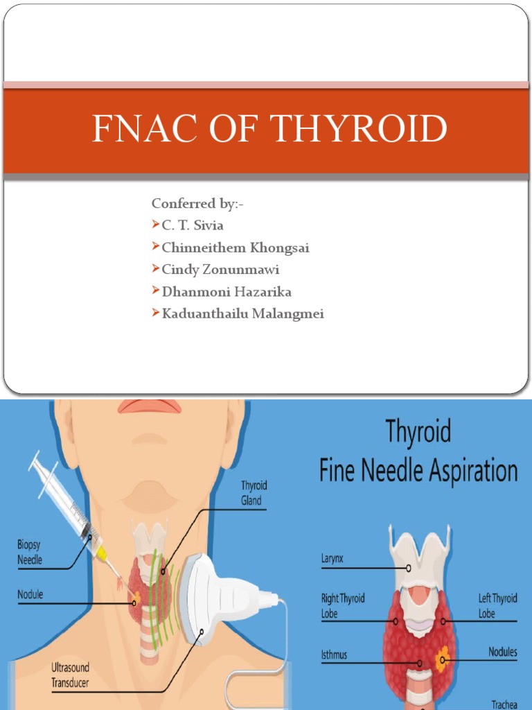 Fnac of Thyroid - 102717 | PDF | Cytopathology | Medicine