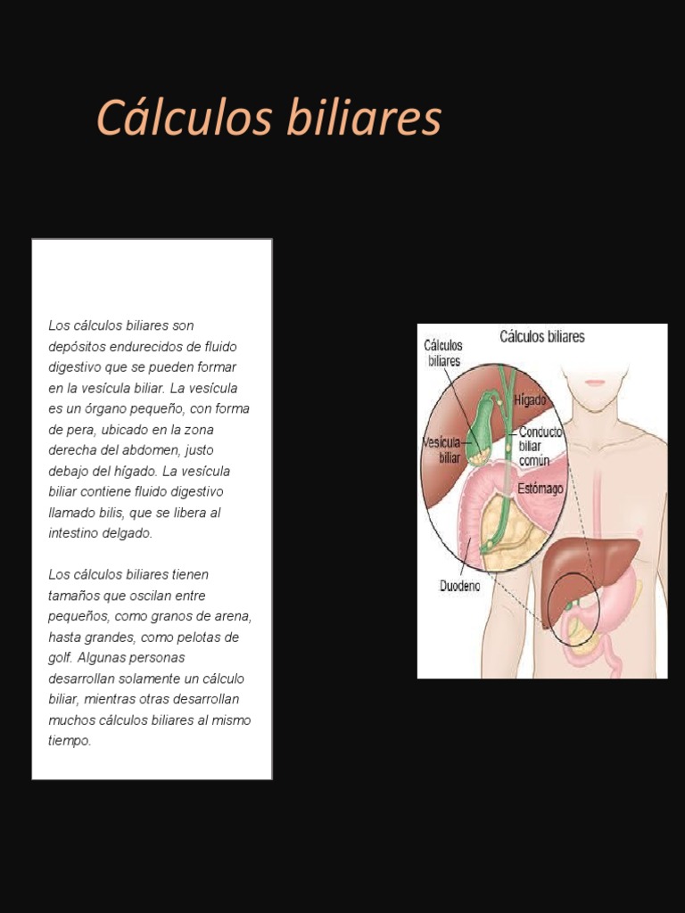 Cálculos Biliares | PDF | Bilis | Vesícula biliar