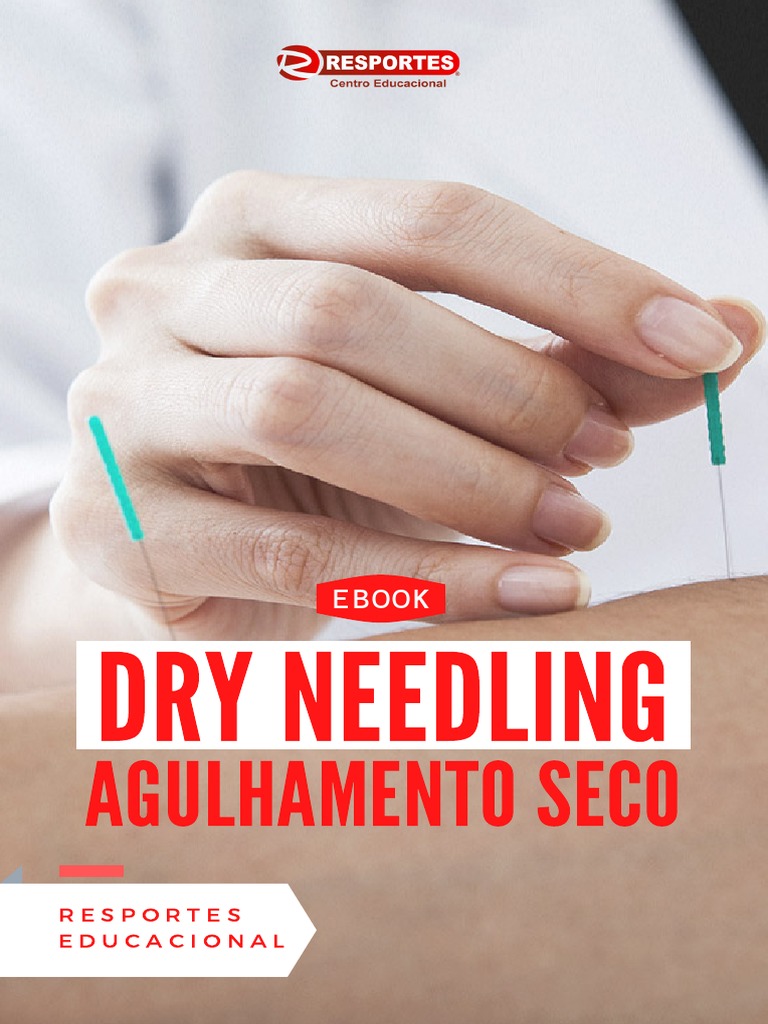 Dry Needling: História e Aplicações | PDF