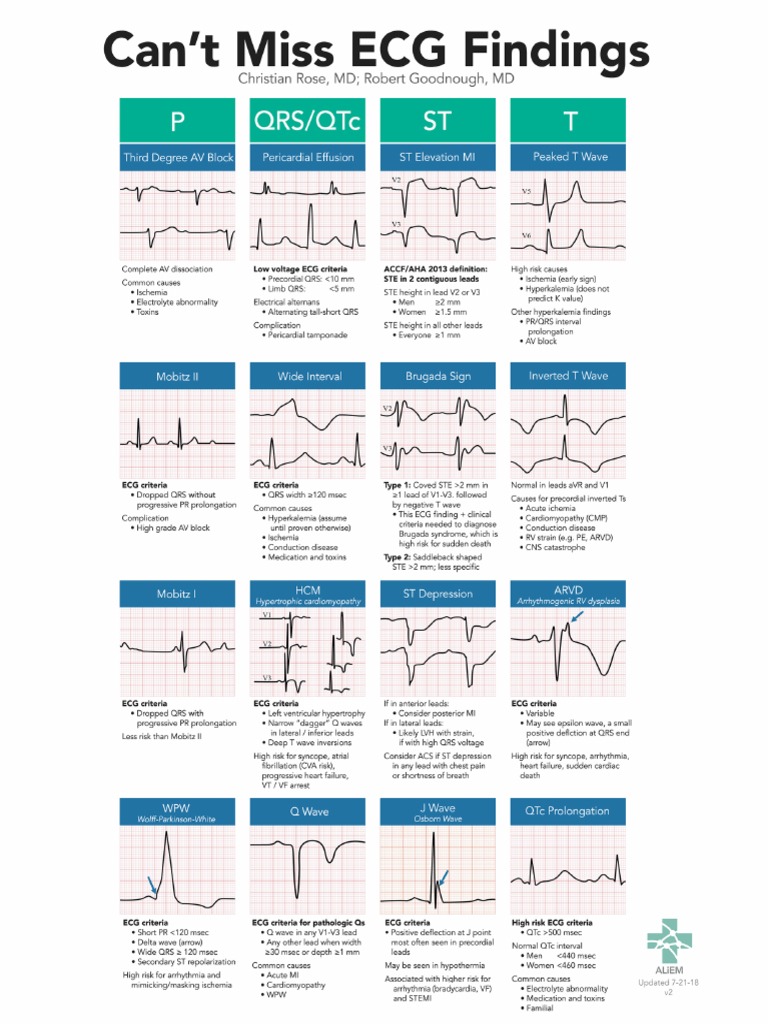 ALiEM Rose Ecg-Cant-Miss-Findings-Card-V2 | PDF