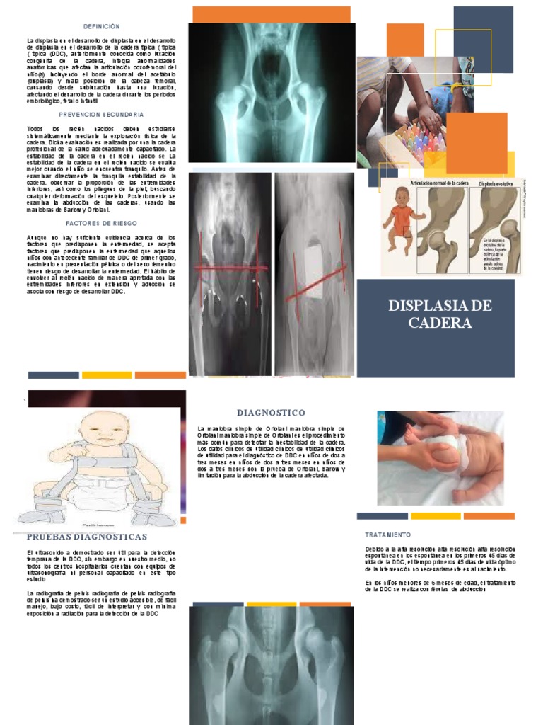 Displasia de Cadera | PDF | Epidemiología | Enfermedades y trastornos