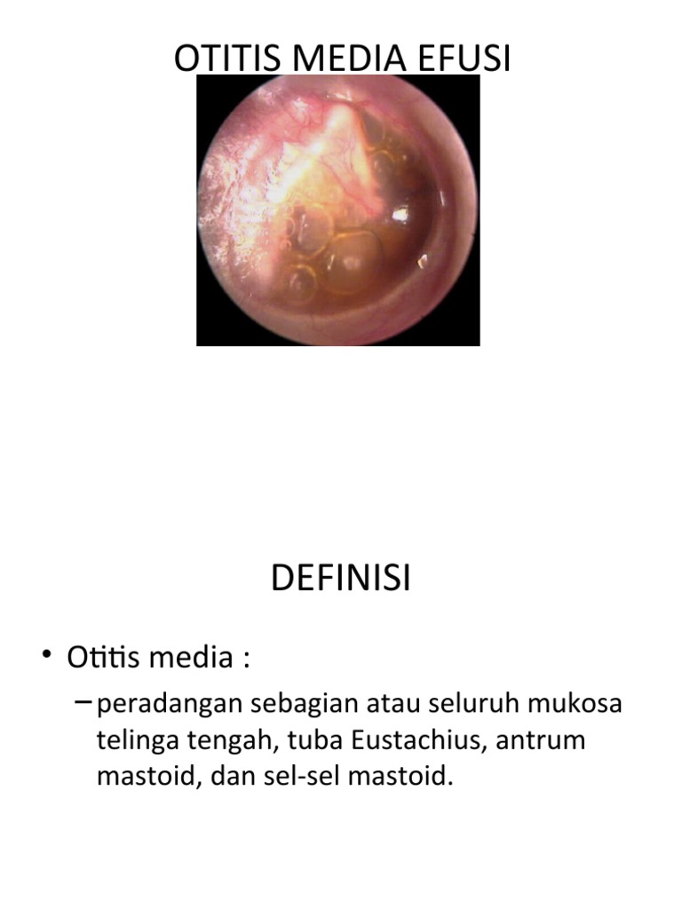 Otitis Media Efusi: Definisi dan Penanganan | PDF | Sains & Matematika