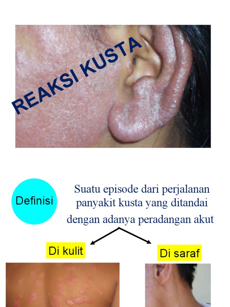 Reaksi Kusta | PDF