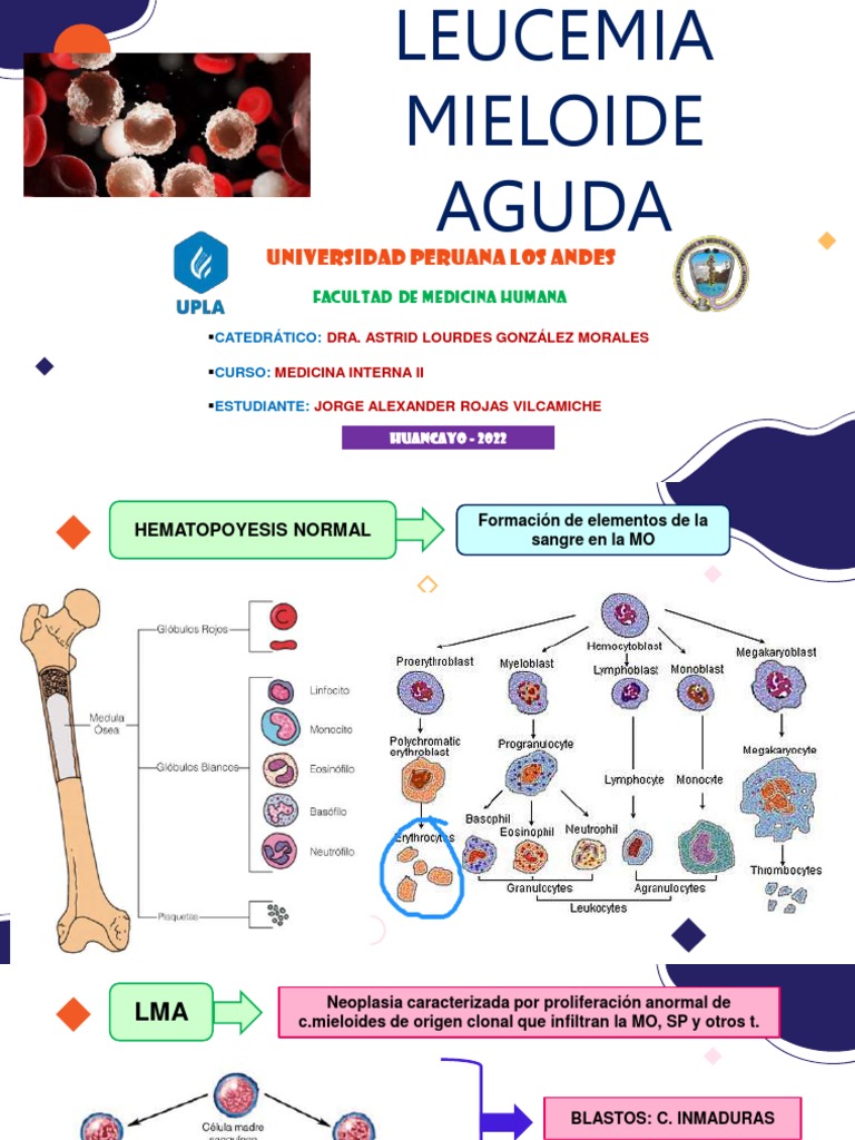 Hemato 7 - Leucemia Mieloide Aguda PDF | PDF | Leucemia | Hematopoyesis